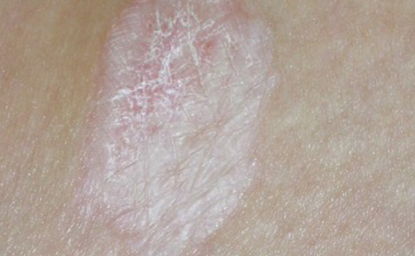 Medical Conditions Archives - Dr. Memon Dermatology